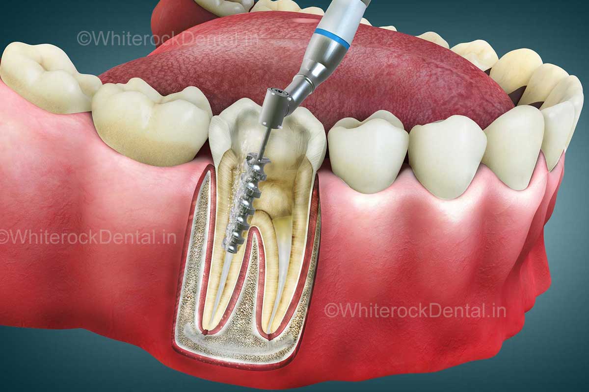 Can You Skip a Root Canal? The Pros and Cons - Whiterock Dental, Wadala