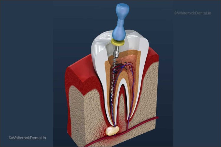 Exposed Nerves: 5 Early Signs You Need Urgent Dental Treatment ...