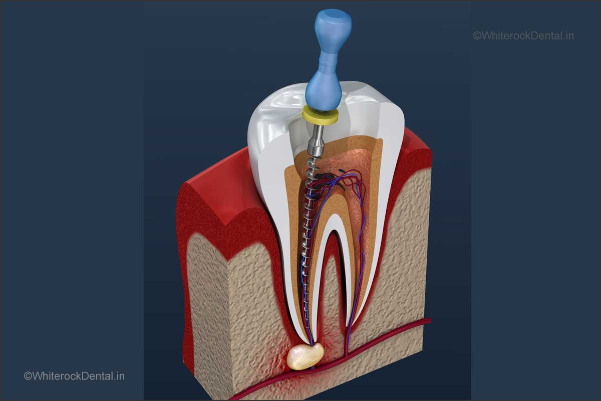 Exposed Nerves: 5 Early Signs You Need Urgent Dental Treatment ...