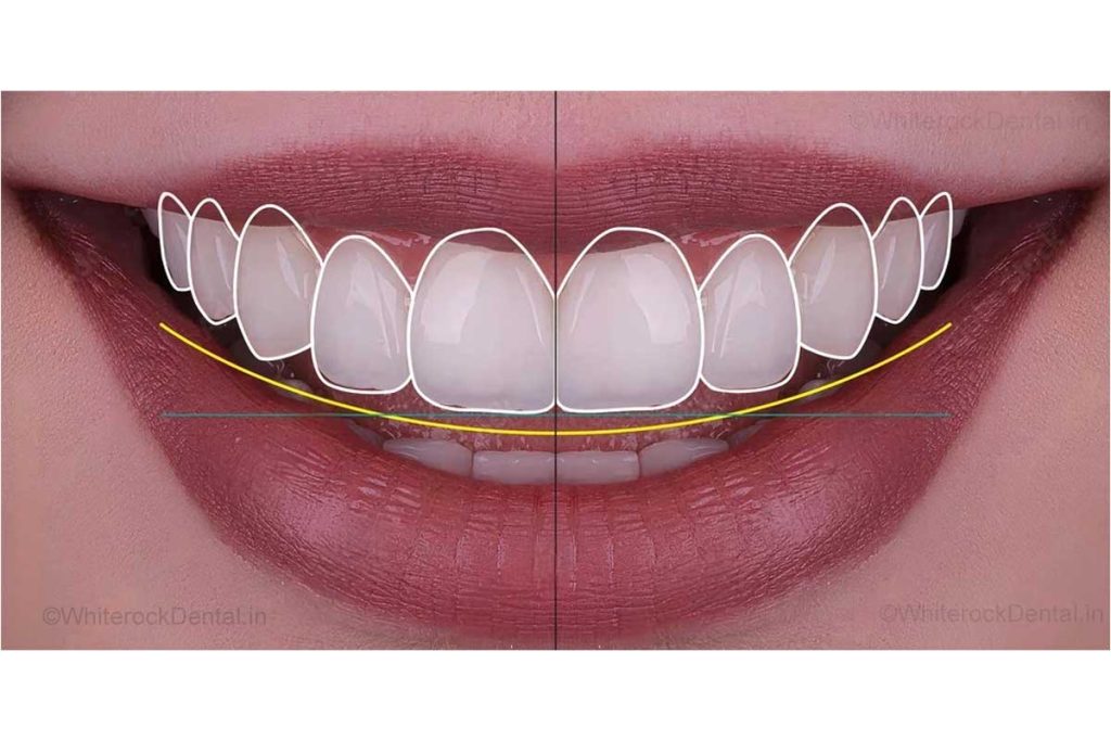 What Is Smile Design? How It Can Transform Your Confidence - Whiterock ...