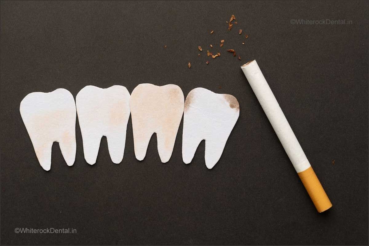 Smoking Stains? Top Teeth Whitening Solutions for Heavy Smokers ...