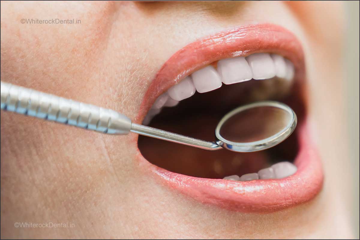 Sedation Root Canal in Mumbai: Relax Through the Entire Procedure ...